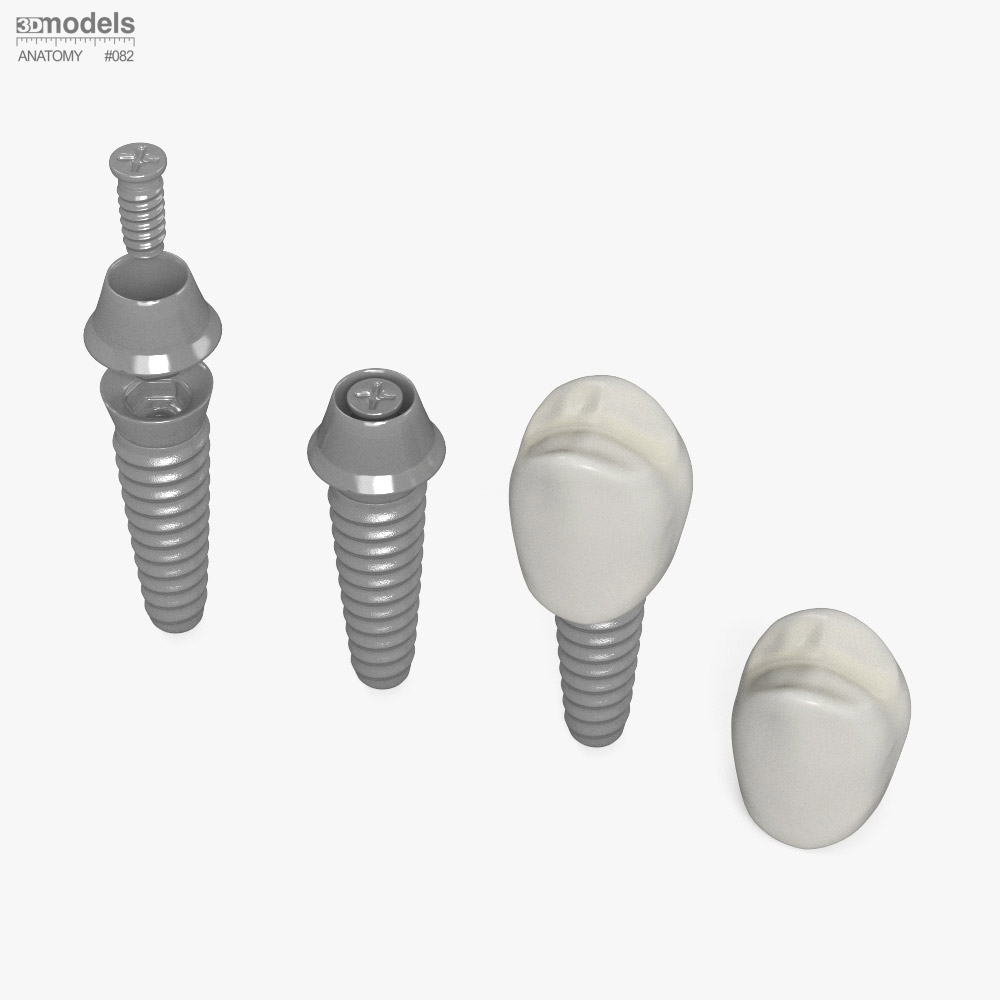 Single Tooth Implant 3D model - Download Anatomy on 3DModels.org